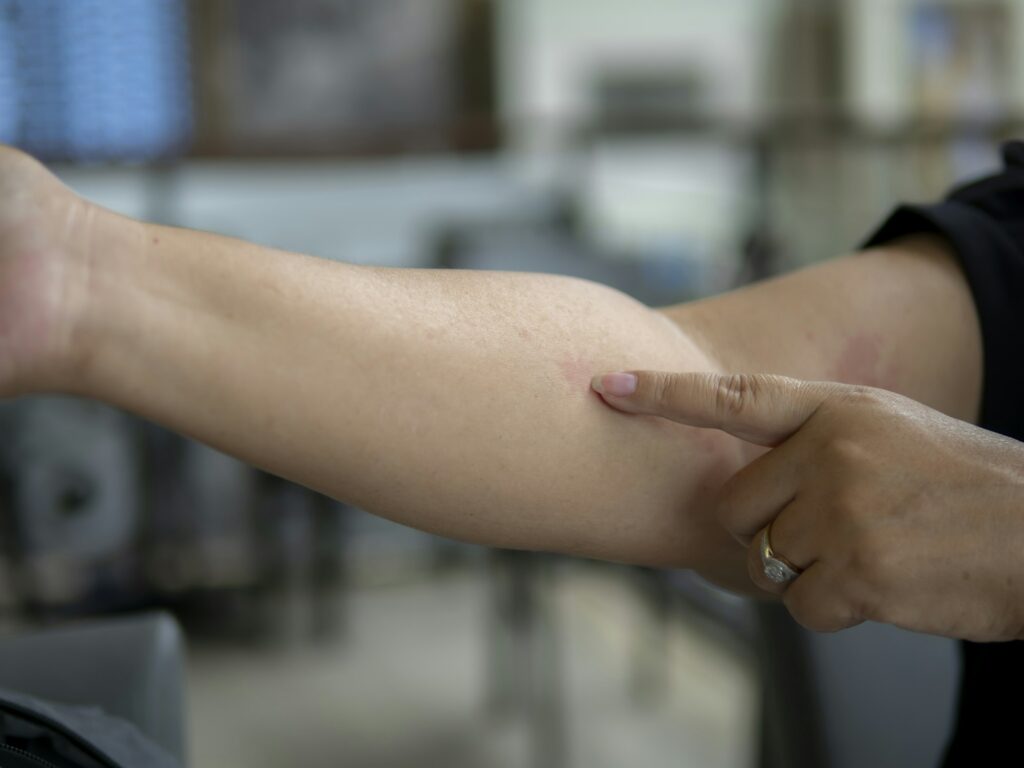 Allergic Reaction To Sun Tan Lotion? Here’s What To Do – Tanning Lotion ...